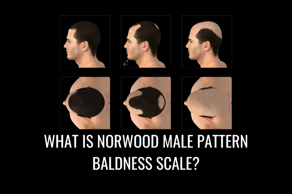 What Is the Norwood Scale? A Guide to Male Pattern Baldness